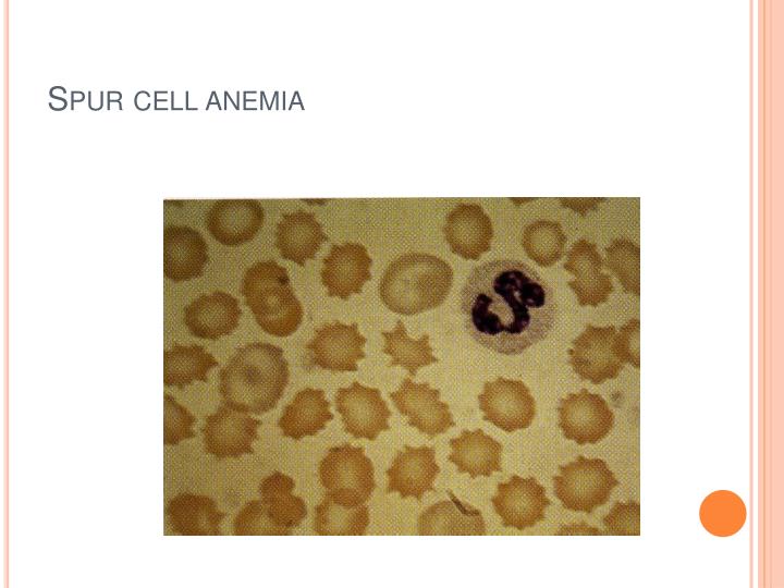PPT - Hemolytic Anemias - Extracorpuscular defects PowerPoint ...