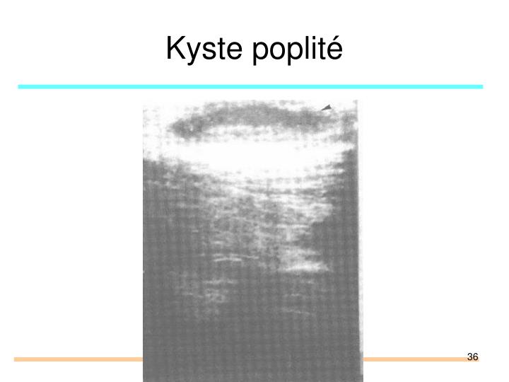 PPT - Pathologie péri-articulaire membre inférieur PowerPoint ...