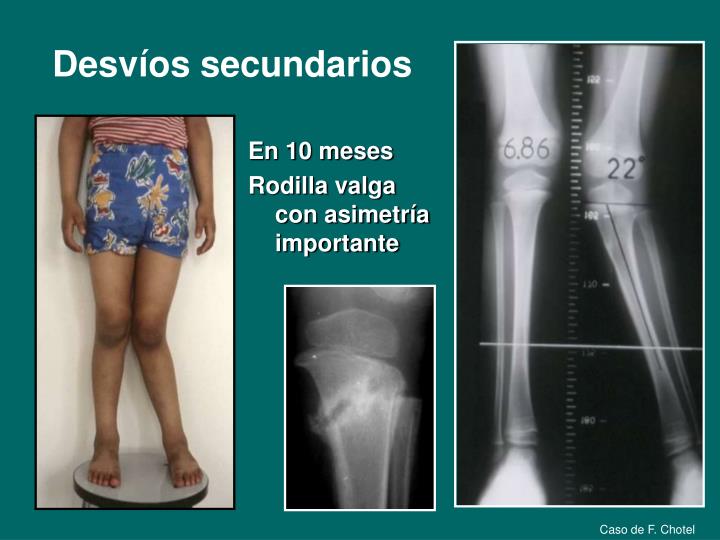 PPT - La rodilla valga PowerPoint Presentation - ID:1271319