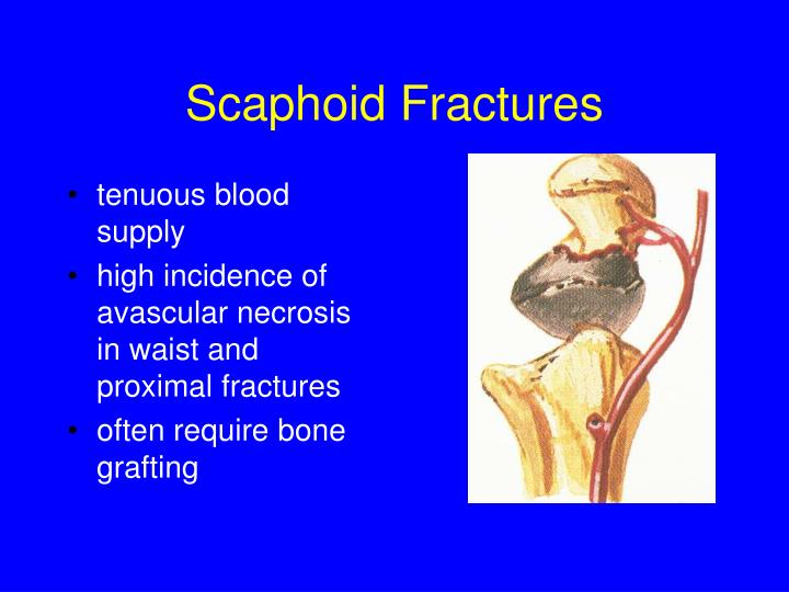 PPT - Orthopedic Injuries and Immobilization PowerPoint Presentation ...
