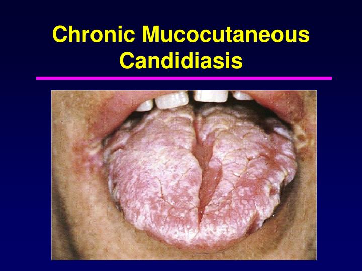 PPT - Recurrent Aphthous Ulcer PowerPoint Presentation - ID:1272543