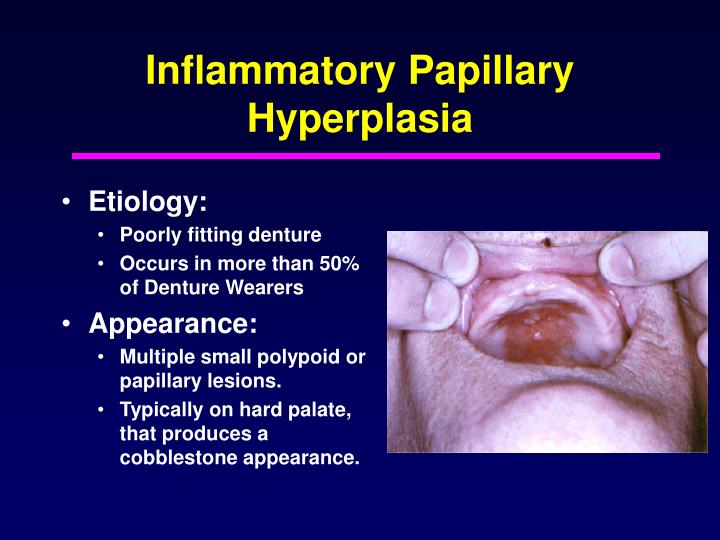 PPT - Recurrent Aphthous Ulcer PowerPoint Presentation - ID:1272543