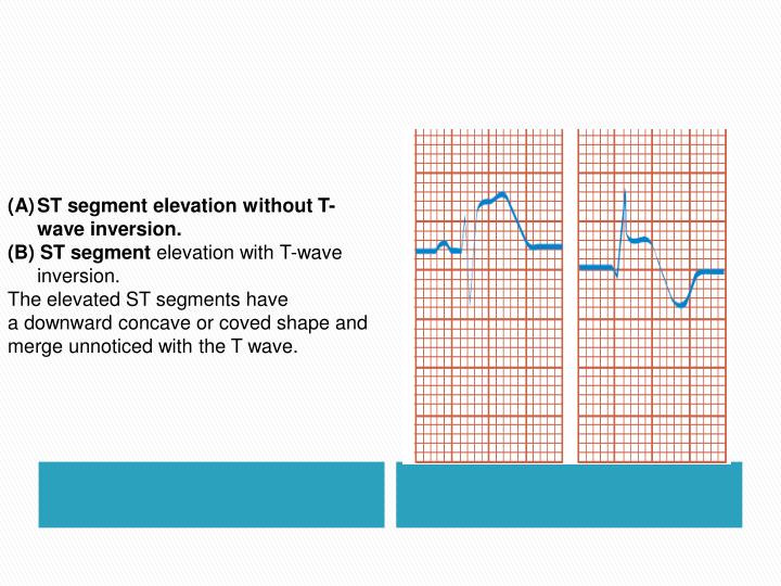 PPT - MYOCARDIAL INFARCTION PowerPoint Presentation - ID:1273379