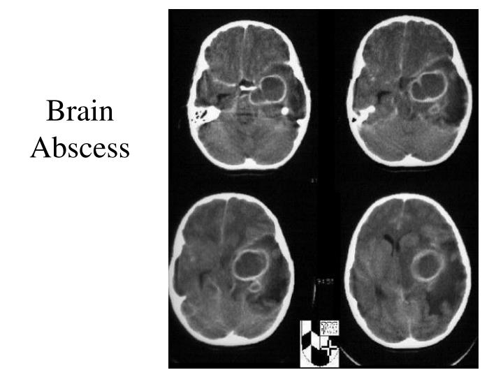 PPT - Chronic Otitis Media (COM) with and without Cholesteatoma ...