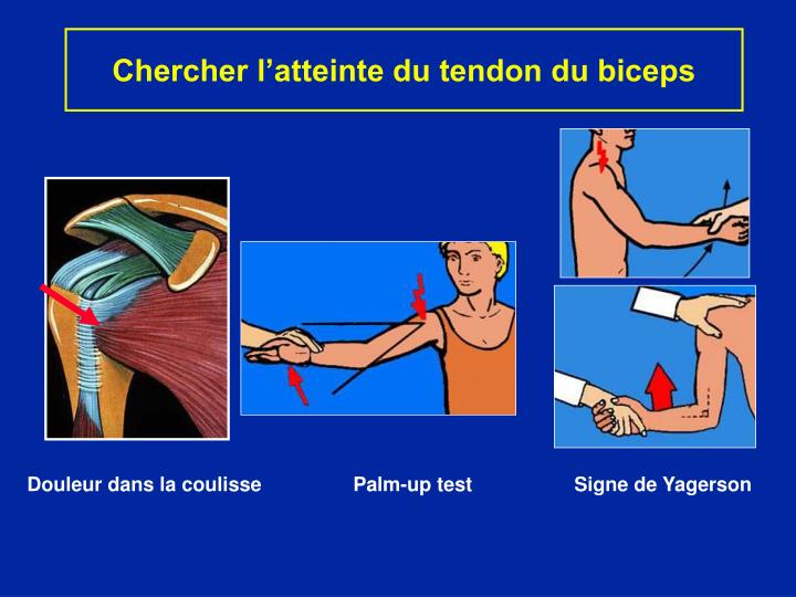 PPT - Rupture de la coiffe des rotateurs PowerPoint Presentation - ID ...