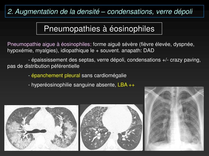 PPT - 6. Pneumopathie interstitielle aiguë (AIP) PowerPoint ...