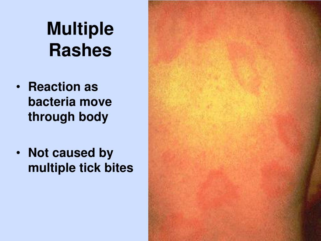 PPT - What You Should Know About Lyme Disease and Other Tick-Borne ...