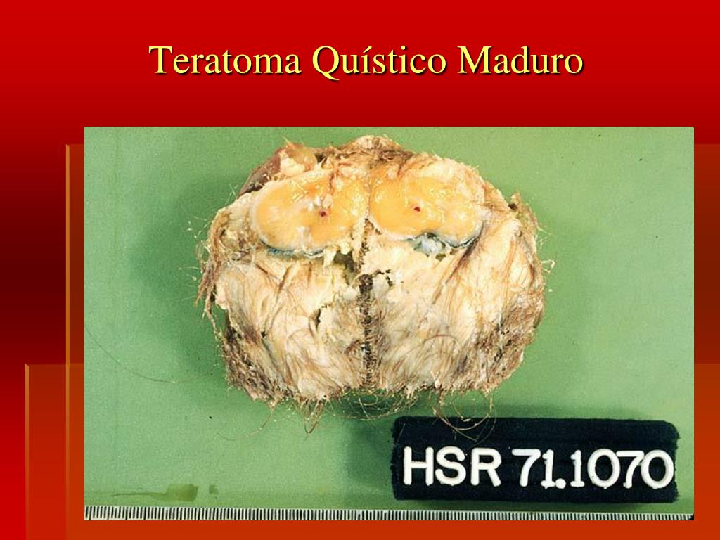 Ppt Tumores De Ovario Powerpoint Presentation Free Download Id 1277328
