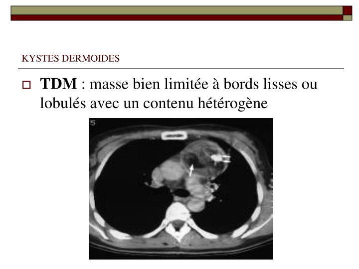 PPT - KYSTES MEDIASTINAUX PowerPoint Presentation - ID:1277382
