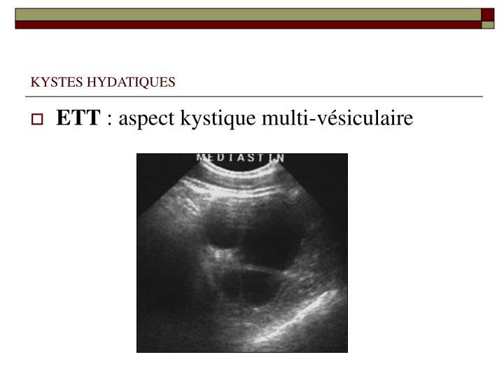 PPT - KYSTES MEDIASTINAUX PowerPoint Presentation - ID:1277382