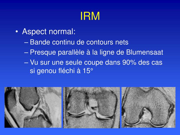 PPT - Imagerie du genou PowerPoint Presentation - ID:1278470