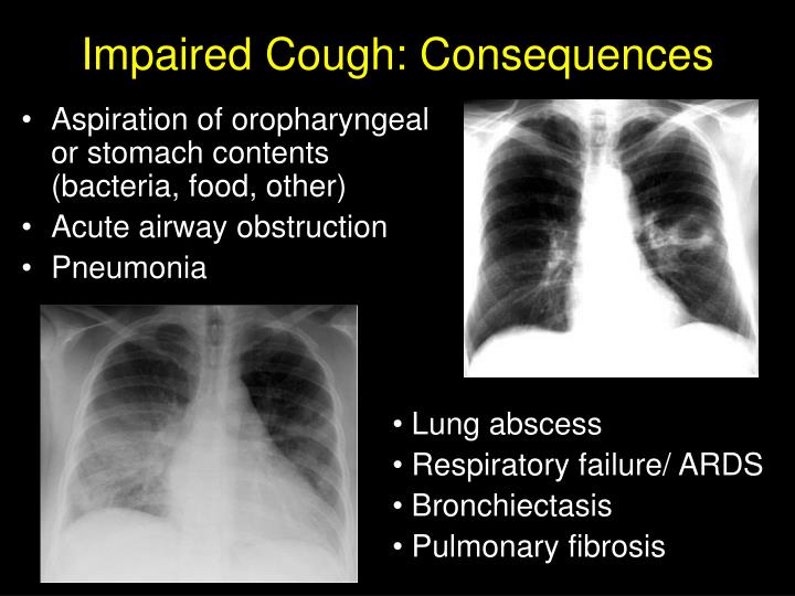 PPT - Cough: Defense Mechanism and Symptom PowerPoint Presentation - ID ...