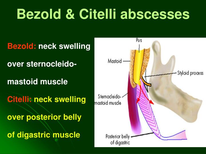 PPT - Acute Suppurative Otitis Media PowerPoint Presentation - ID:1287636