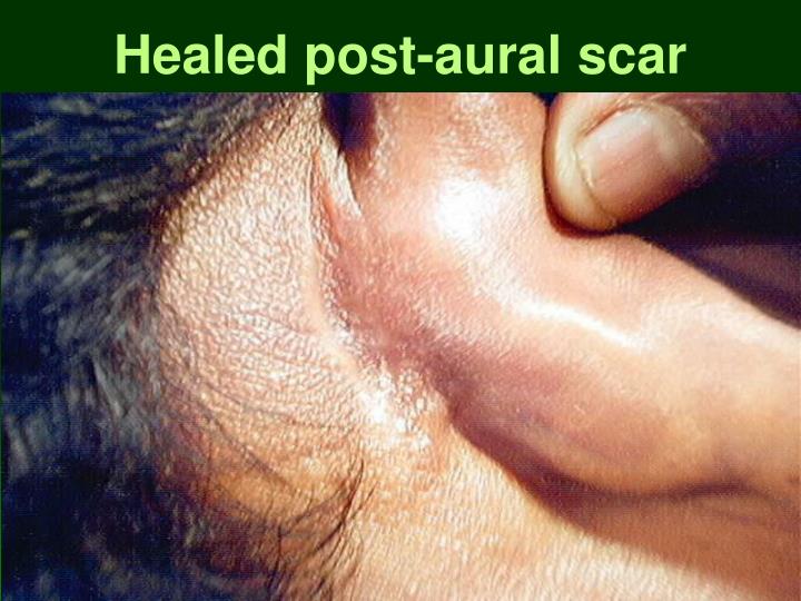 PPT - Acute Suppurative Otitis Media PowerPoint Presentation - ID:1287636