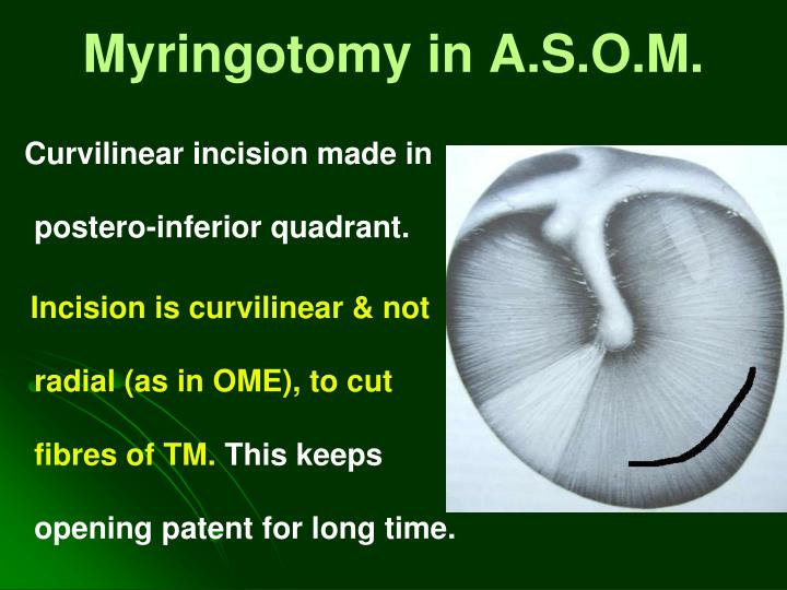 PPT - Acute Suppurative Otitis Media PowerPoint Presentation - ID:1287636