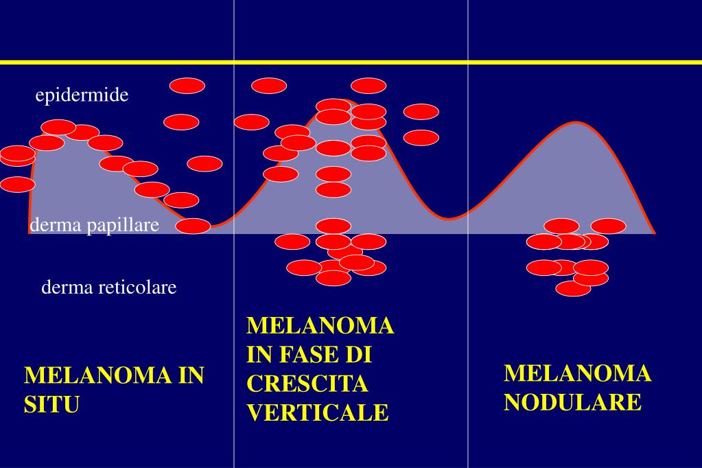 PPT - NEVI E MELANOMI CUTANEI IN ETA’ PEDIATRICA PowerPoint ...