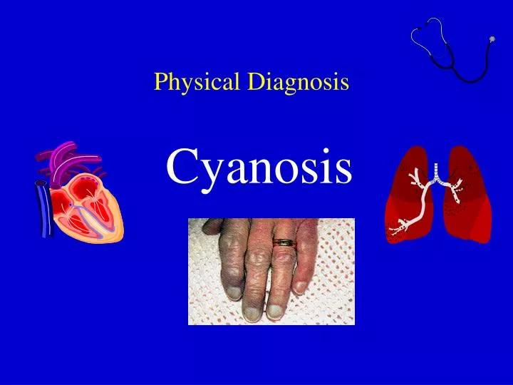PPT - Physical Diagnosis Cyanosis PowerPoint Presentation, free ...