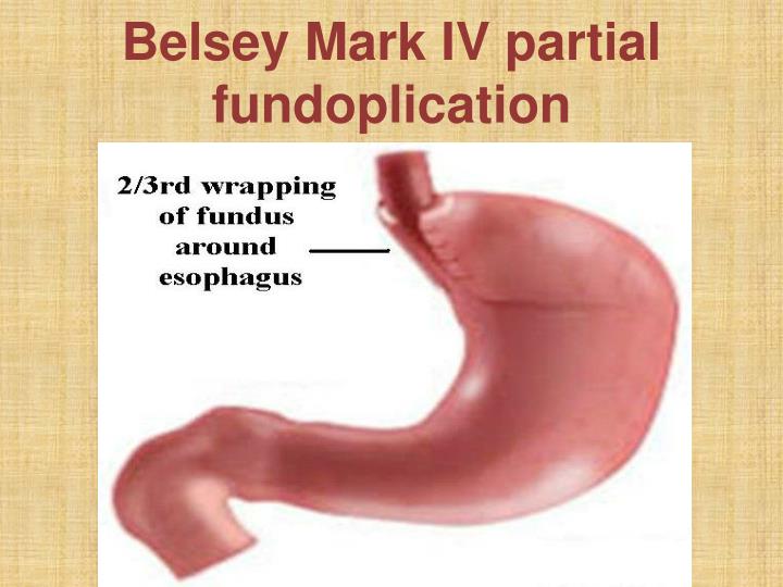 PPT - Diseases of Esophagus & Dysphagia PowerPoint Presentation - ID ...