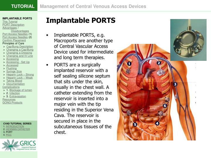 PPT - 3. IMPLANTABLE PORTS PowerPoint Presentation - ID:1294487