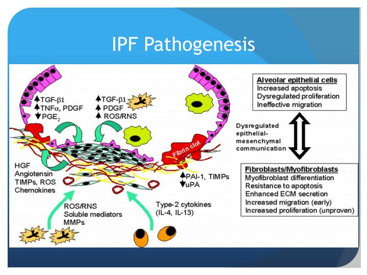 PPT - Research and Development in Pulmonary Fibrosis: The Future is ...