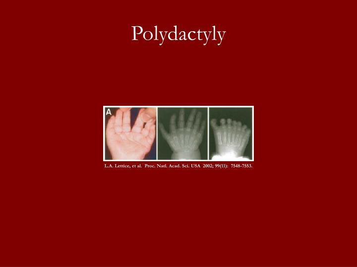 PPT - Polydactyly PowerPoint Presentation, free download - ID:1297709