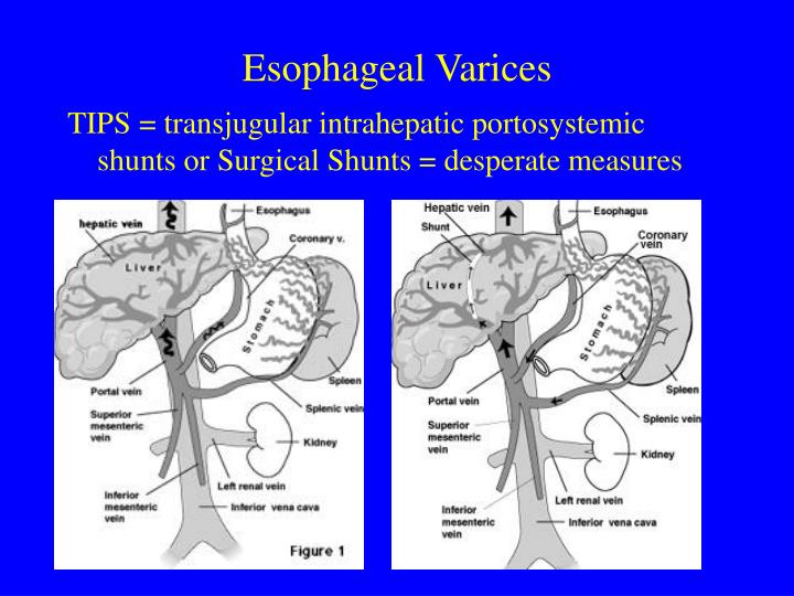 PPT - UGI Bleeding PowerPoint Presentation - ID:1301848