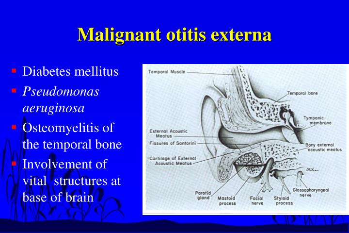 PPT - Upper Respiratory Tract Infections PowerPoint Presentation - ID ...