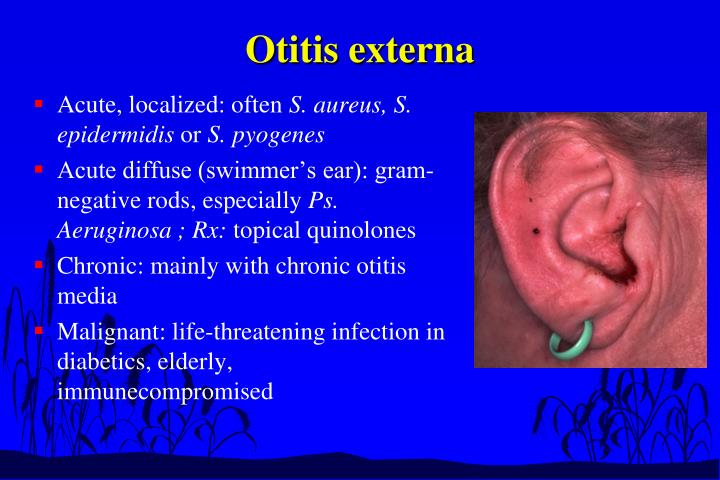 Bacterial Otitis Externa