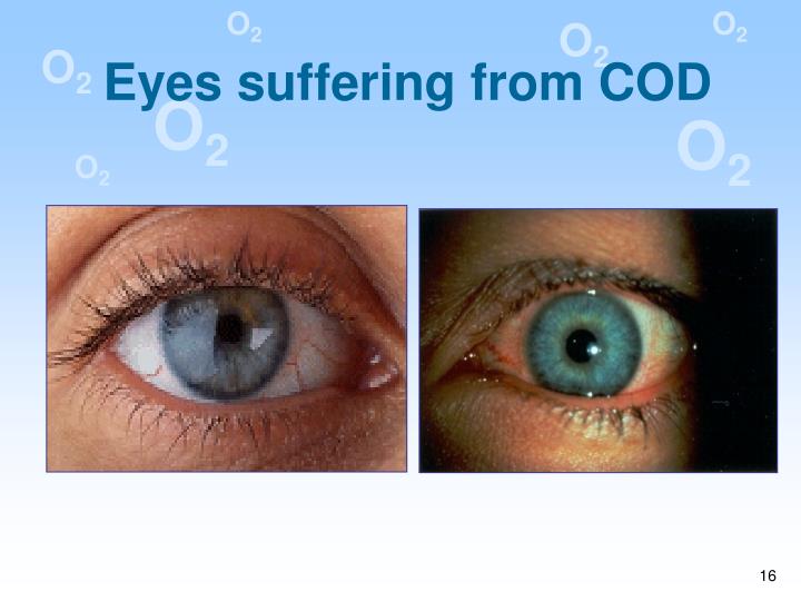 PPT - Corneal Oxygen Deficiency PowerPoint Presentation - ID:1309617