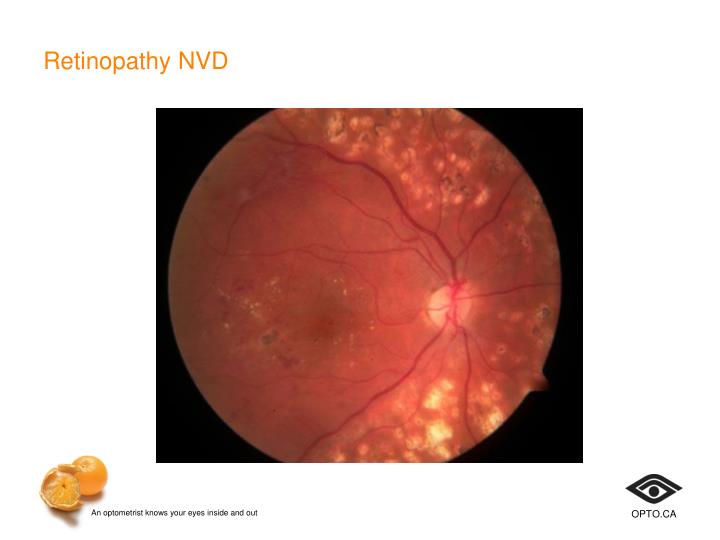 PPT - Diabetes and the Eye PowerPoint Presentation - ID:1310383