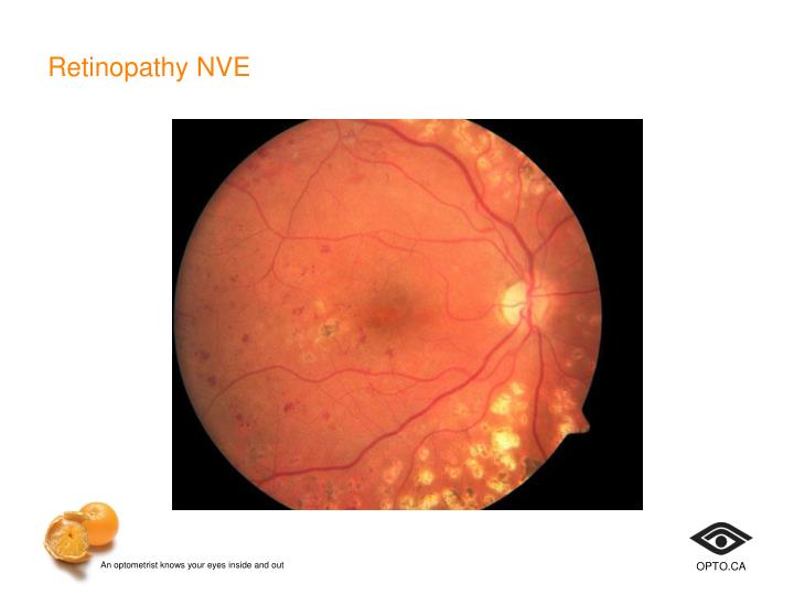 PPT - Diabetes and the Eye PowerPoint Presentation - ID:1310383