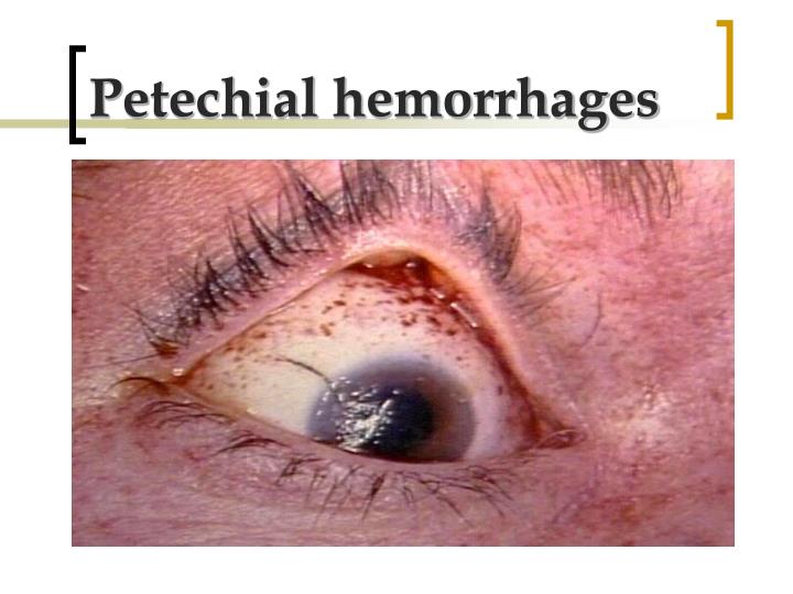 PPT - Presence of periorbital and conjunctival petechial hemorrhages in ...