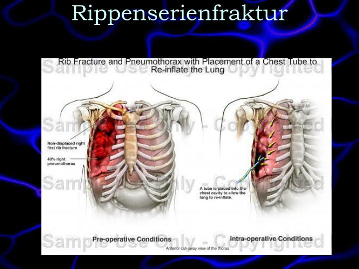 PPT - Thoraxtrauma PowerPoint Presentation - ID:1315193