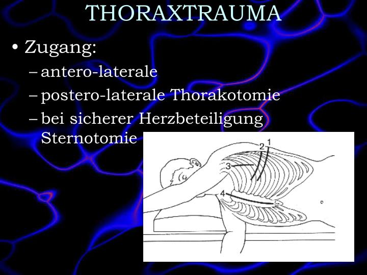 PPT - Thoraxtrauma PowerPoint Presentation - ID:1315193