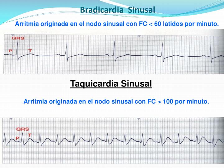 PPT - ARRITMIAS PowerPoint Presentation - ID:1316649