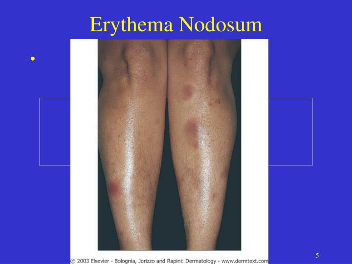 PPT - Diseases of Subcutaneous Fat. Endocrine Diseases. PowerPoint ...