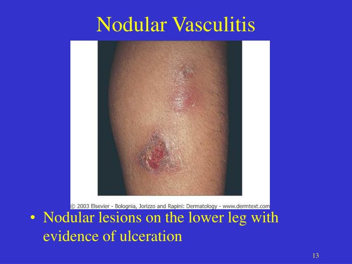 PPT - Diseases of Subcutaneous Fat. Endocrine Diseases. PowerPoint ...