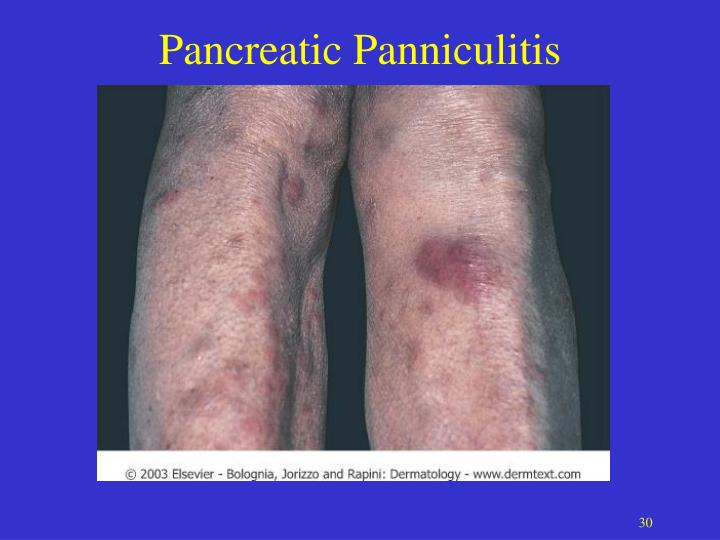 PPT - Diseases of Subcutaneous Fat. Endocrine Diseases. PowerPoint ...