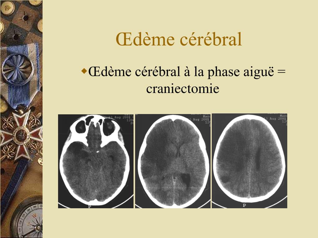 PPT - L’Accident Vasculaire Cérébral du sujet jeune PowerPoint ...
