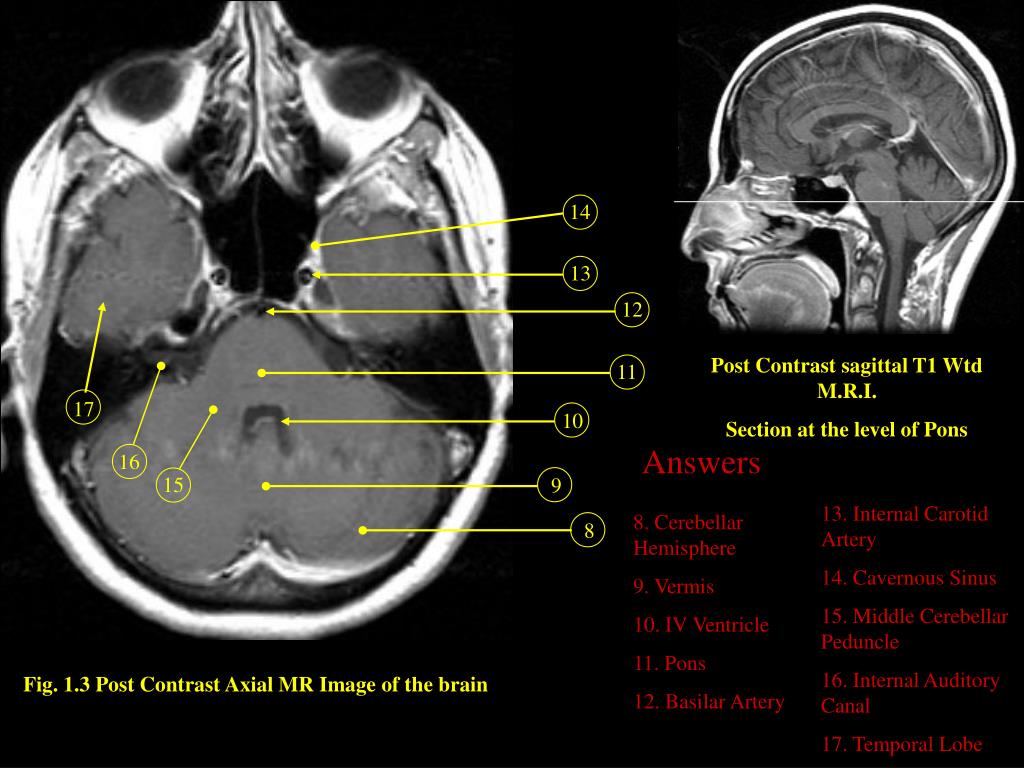 PPT Anatomy Of Brain By Magnetic Resonance Imaging MRI PowerPoint