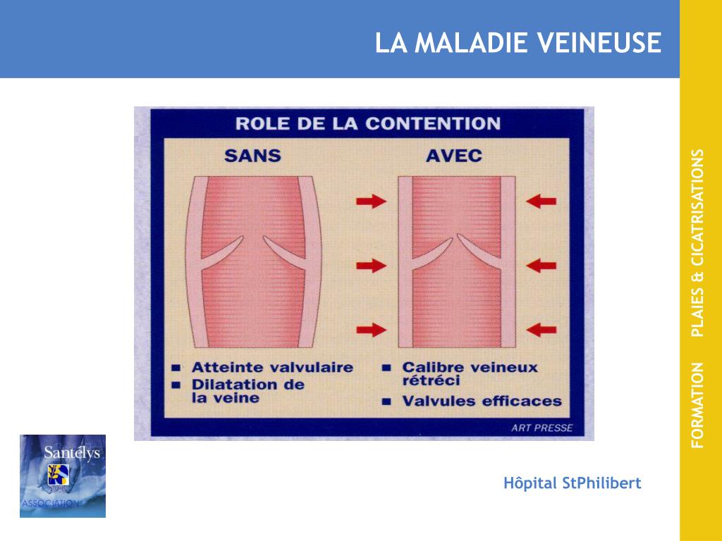 PPT - « La contention, enjeux majeur dans la prise en charge des plaies ...