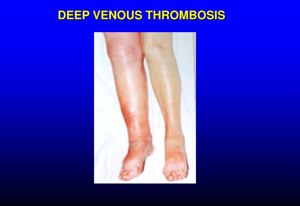 PPT - PATHOPHYSIOLOGY OF THROMBOSIS “Virchow’s Triad” PowerPoint ...