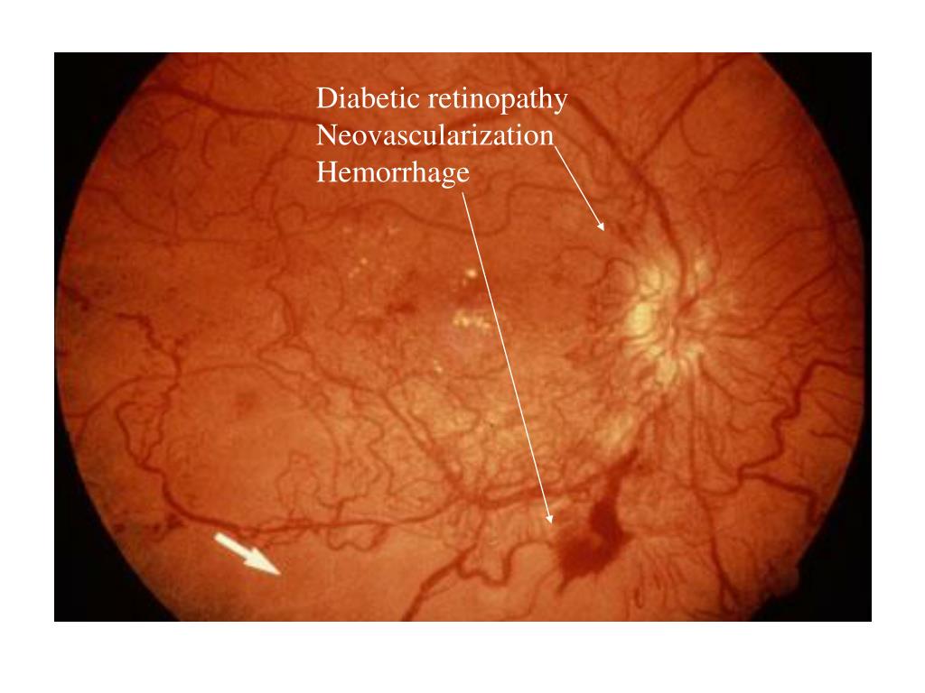 PPT - Identify Vein, artery, disc, optic cup, fovea PowerPoint ...