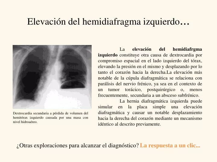 PPT - Elevación del hemidiafragma izquierdo ... PowerPoint Presentation ...