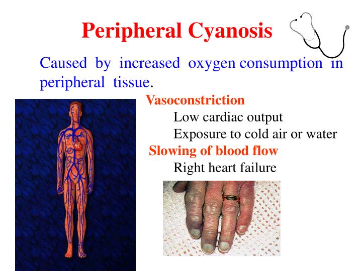 PPT - Cyanosis PowerPoint Presentation - ID:1341572