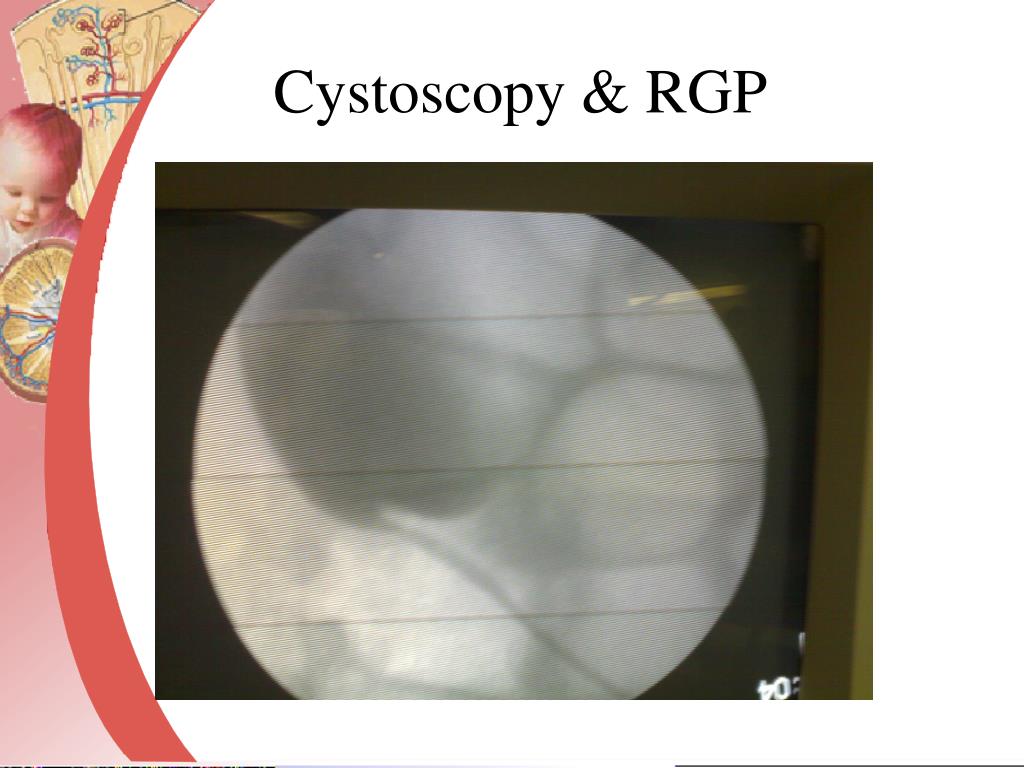 PPT - PUJ in Horse Shoe Kidney PowerPoint Presentation, free download ...