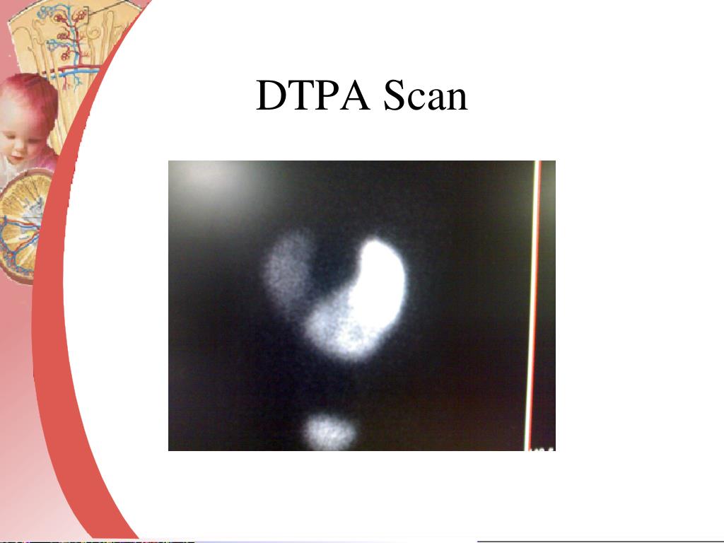 PPT - PUJ in Horse Shoe Kidney PowerPoint Presentation, free download ...