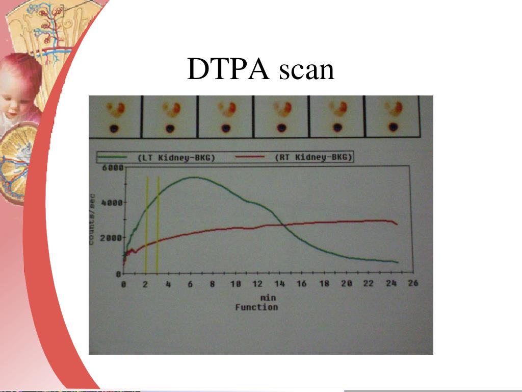 PPT - PUJ in Horse Shoe Kidney PowerPoint Presentation, free download ...