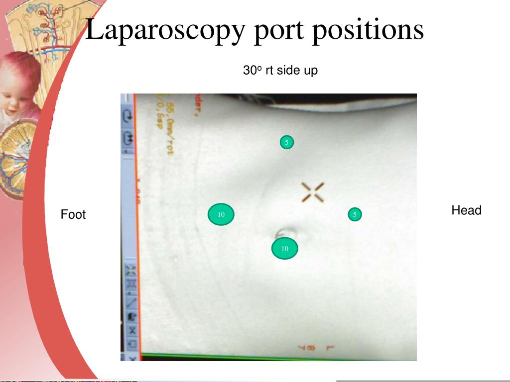 PPT - PUJ in Horse Shoe Kidney PowerPoint Presentation, free download ...