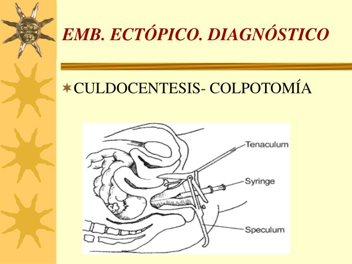 PPT - Embarazo Ectópico PowerPoint Presentation - ID:1346062